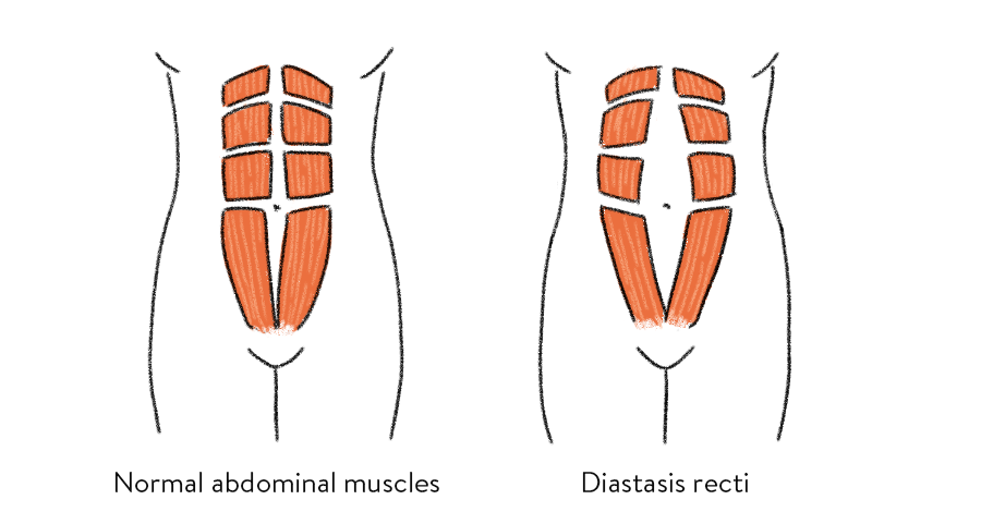 Understanding Diastasis Recti (Abdominal Separation)