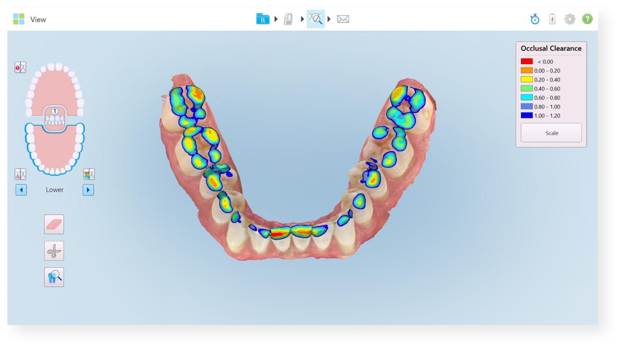 Restorative treatments | iTero
