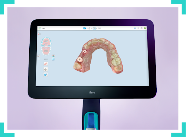 iTero