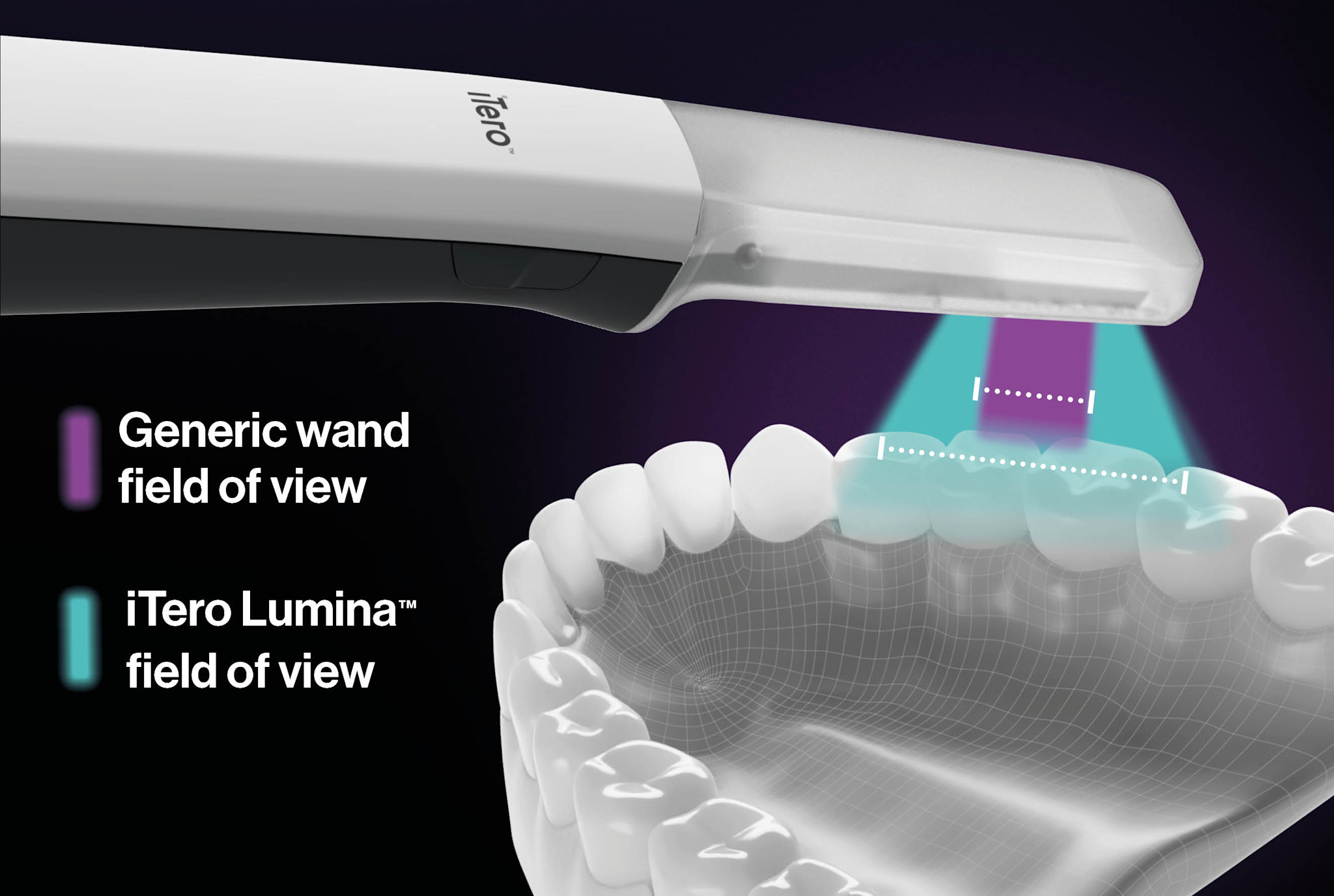 iTero Lumina™ intraoral scanner | iTero
