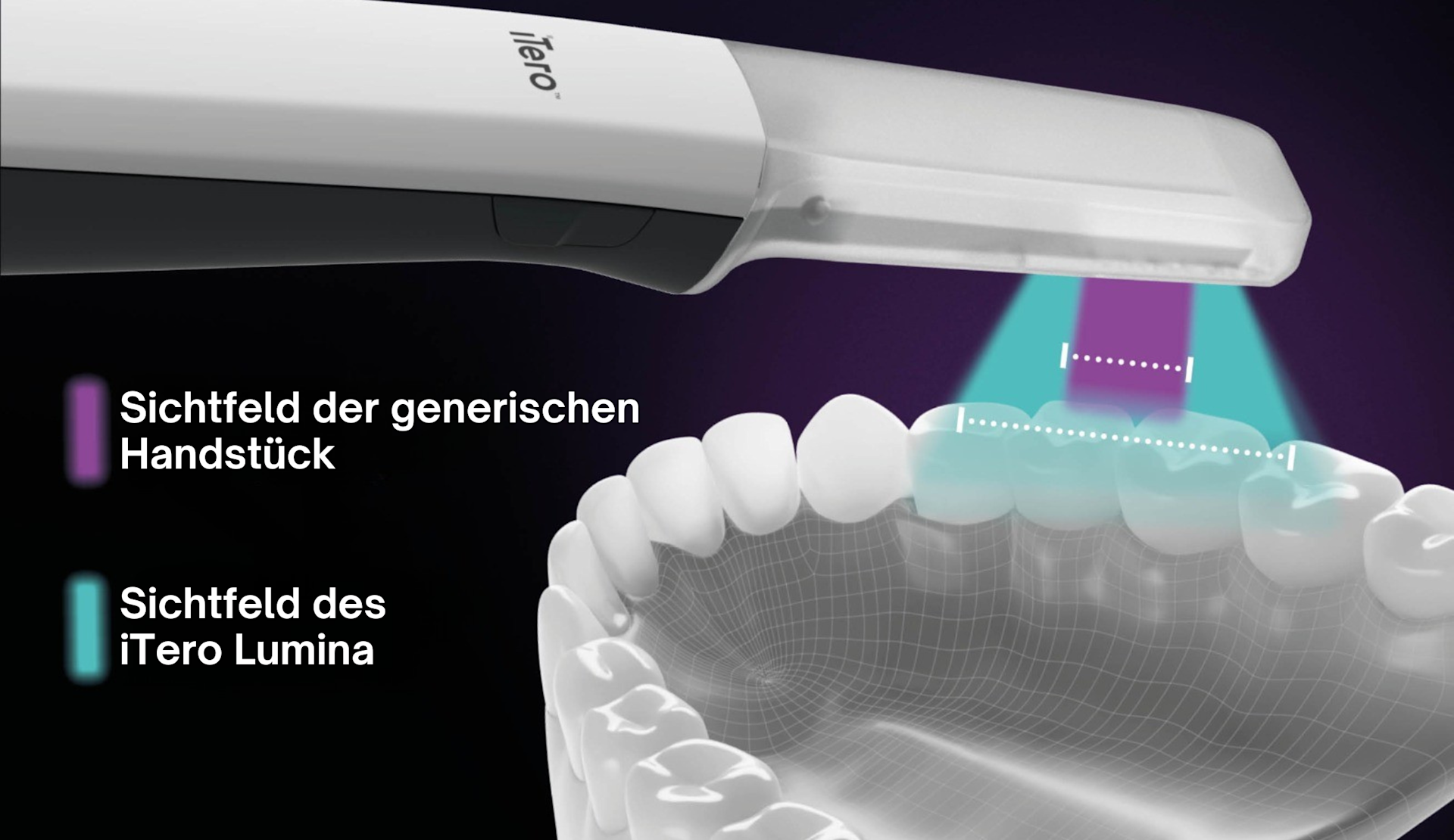 iTero Lumina™ Intraoralscanner | iTero
