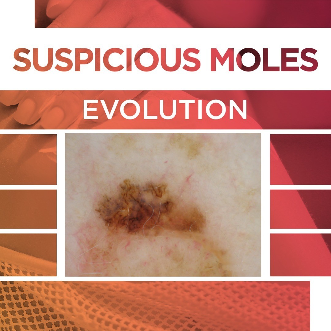 How to check your moles for signs of skin cancer | Lorraine