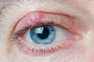 Chalazion Healthily