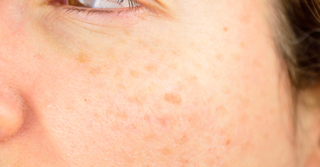 Woman with Solar lentingo on face