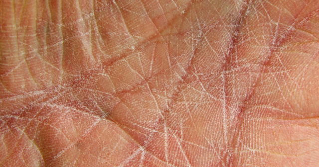 What is mild dry skin?