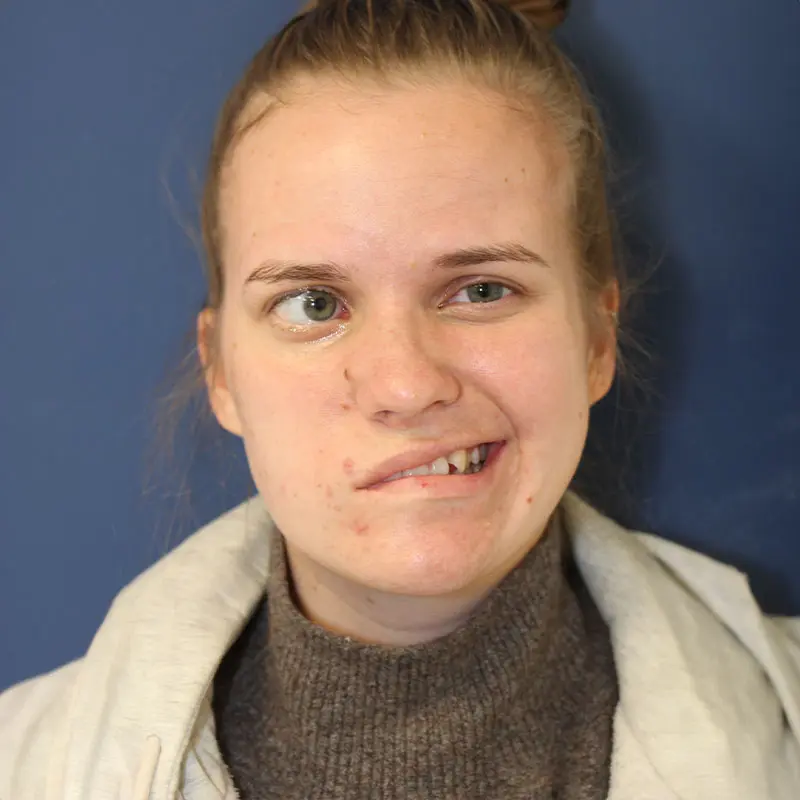 Helping Facial Paralysis Patients Regain Their Natural Smiles