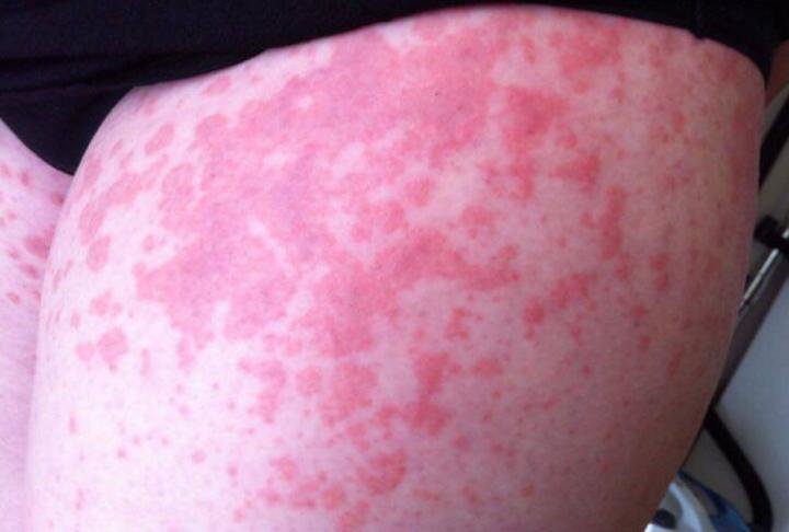 Pregnancy Complication Caused This Woman's Horrific Rash | CafeMom.com