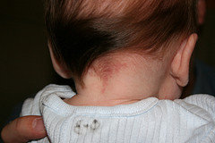 What You Should Know About Birthmarks | CafeMom.com