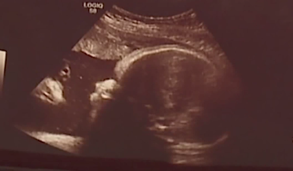 Photos Show Ghosts in Babies' Sonograms | CafeMom.com