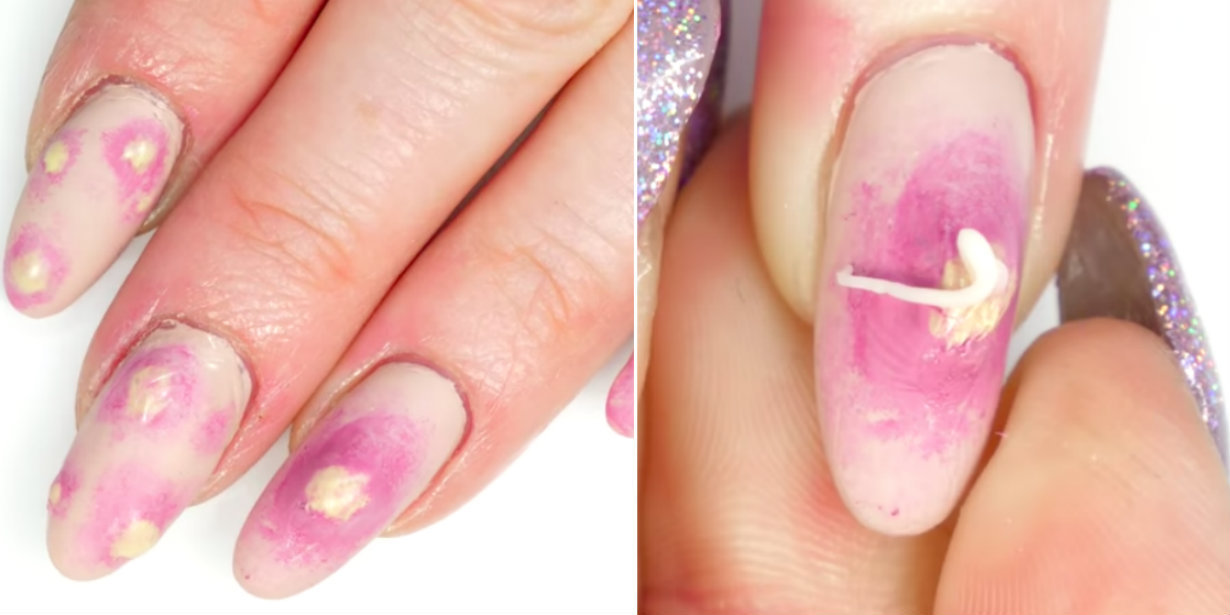 Poppable Zit Nails Are Here & Just Try Not to Gag | CafeMom.com