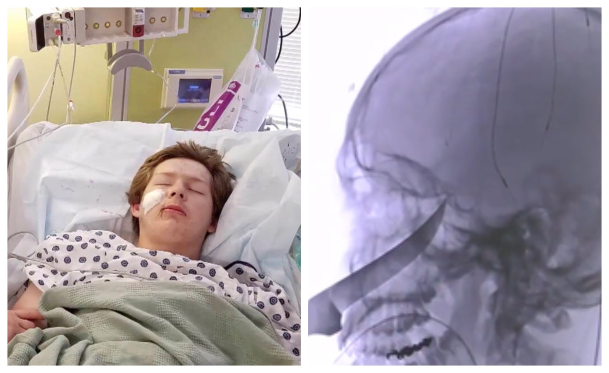 Teenager Impaled with 10-Inch Knife Survives | CafeMom.com