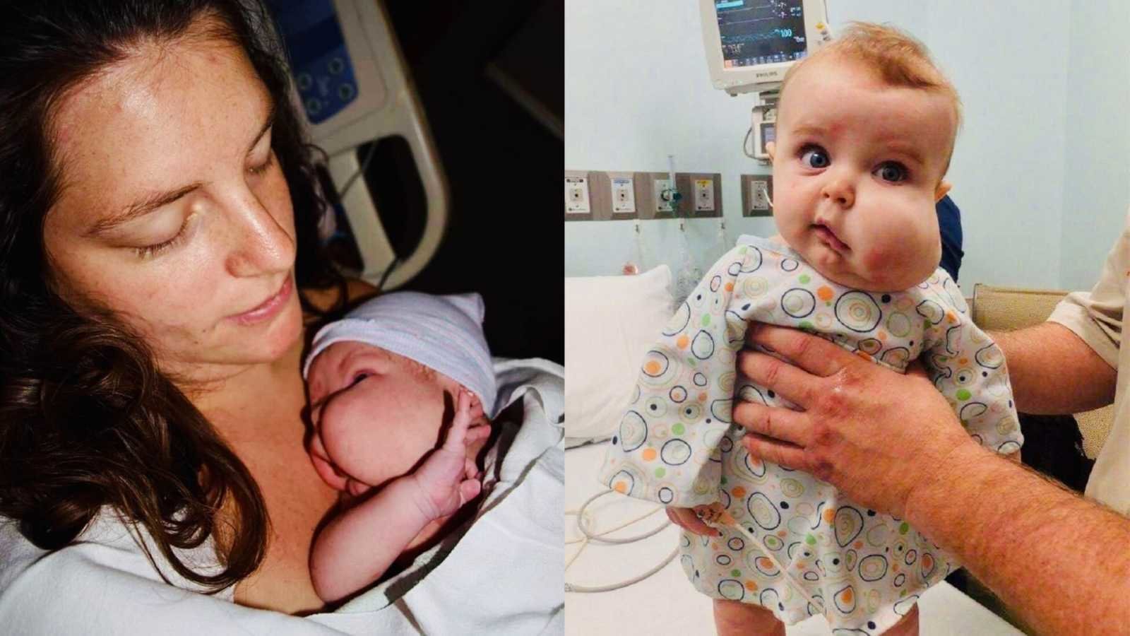 Mom Shares the Story of Her Son's Lymphatic Malformation | CafeMom.com