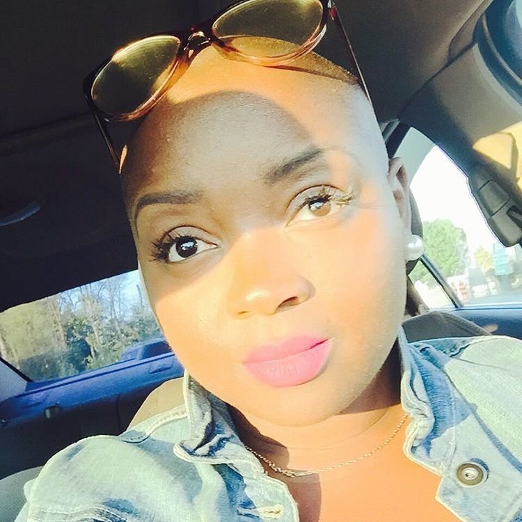 11 photos that show what it's like to live with alopecia | CafeMom.com