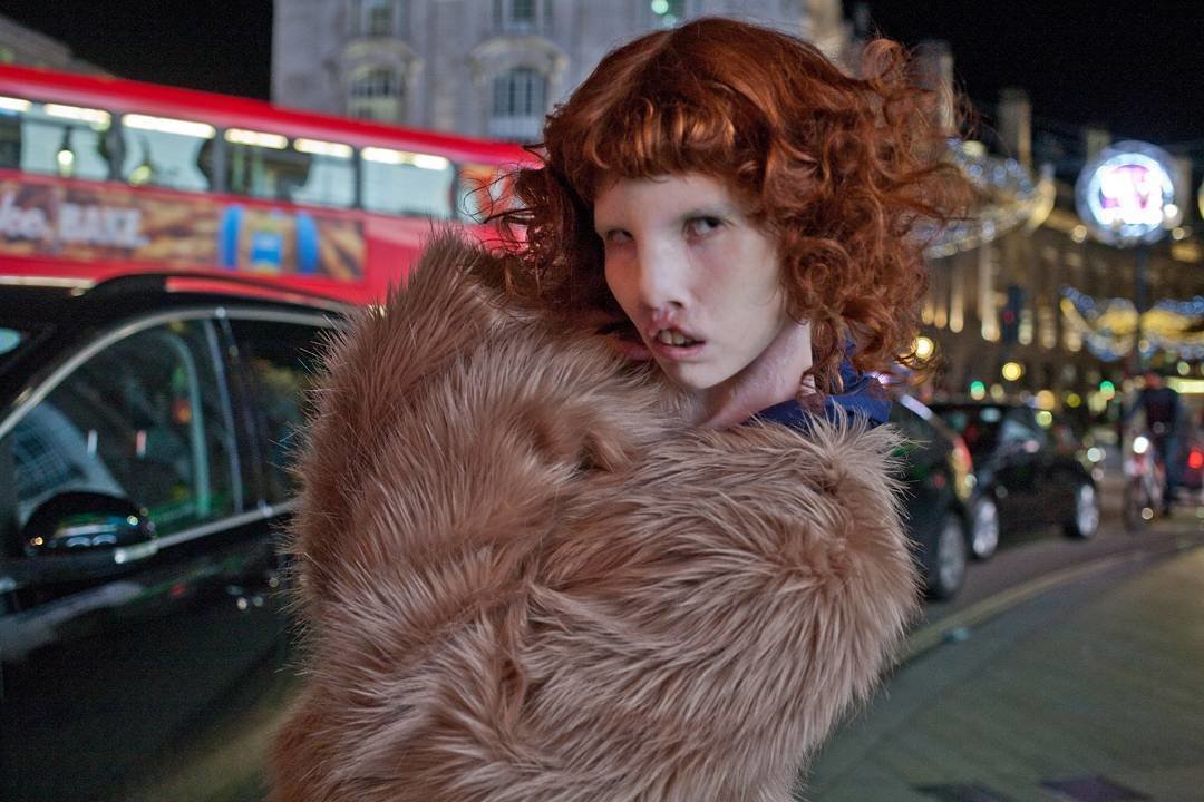 A model with 'cat eye syndrome' is fashion's new muse | CafeMom.com