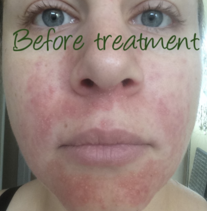 Woman Used Honey to Cure Her Severe Dermatitis Outbreak | CafeMom.com