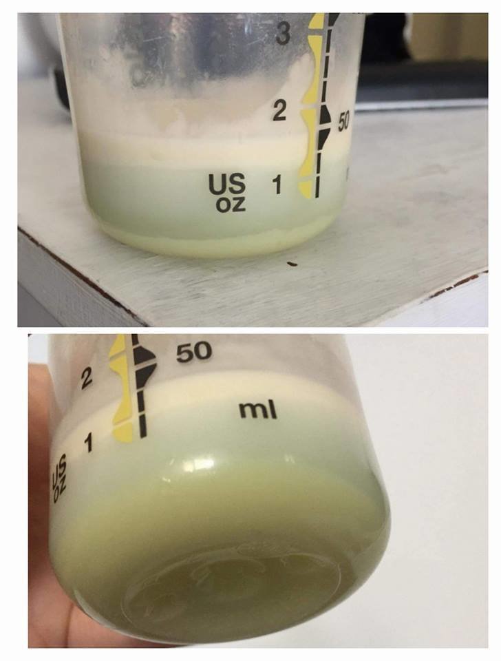 Bloody Breast Milk Photo Shows the Reality of Clogged Ducts | CafeMom.com