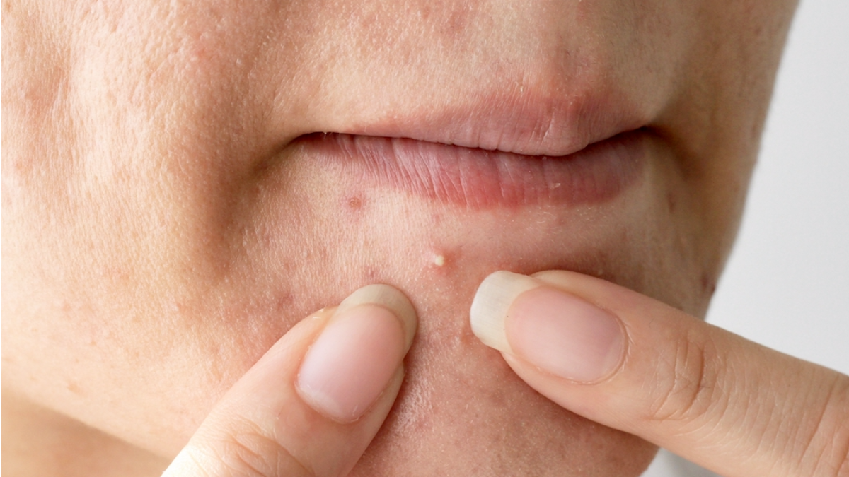 6 ways you're popping your pimples all wrong | CafeMom.com