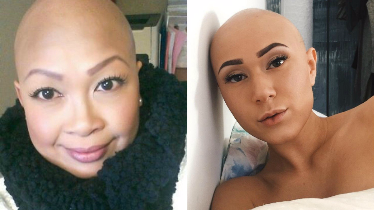 11 photos that show what it's like to live with alopecia | CafeMom.com