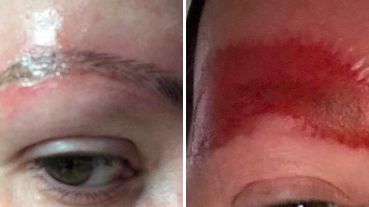 This woman's skin fell off due to a sketchy microblading salon ...