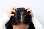 Reasons For Dandruff In Summer Head And Shoulders IN