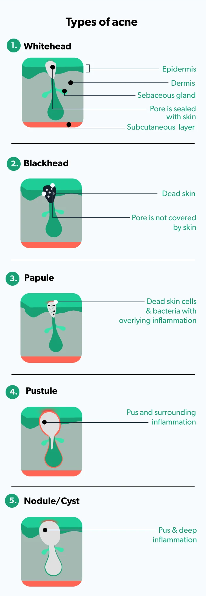 whitehead blackhead difference