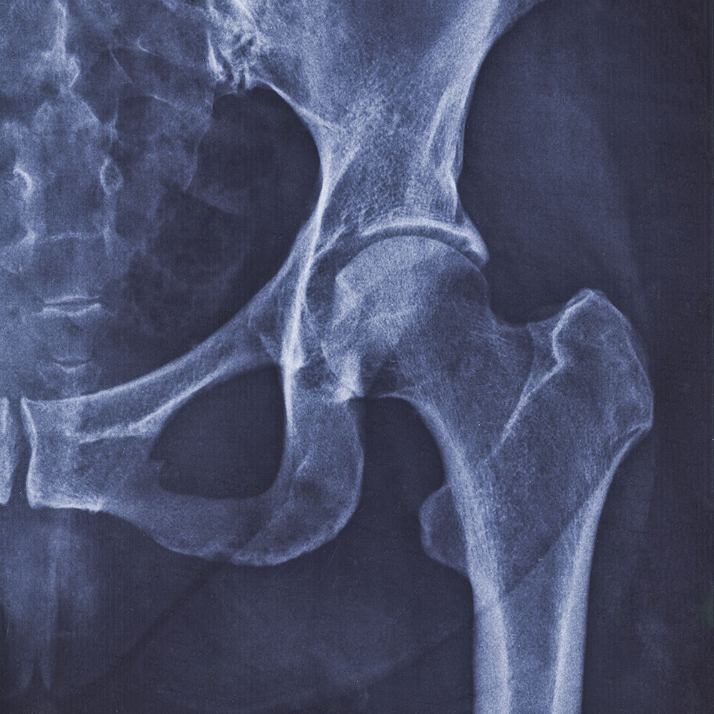 Osteopenia vs. Osteoporosis: What's the Difference? | Ro