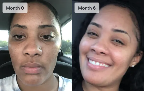 Custom Prescription Skincare Dermatology RX Treatment | Ro