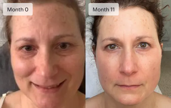 Custom Prescription Skincare Dermatology RX Treatment | Ro