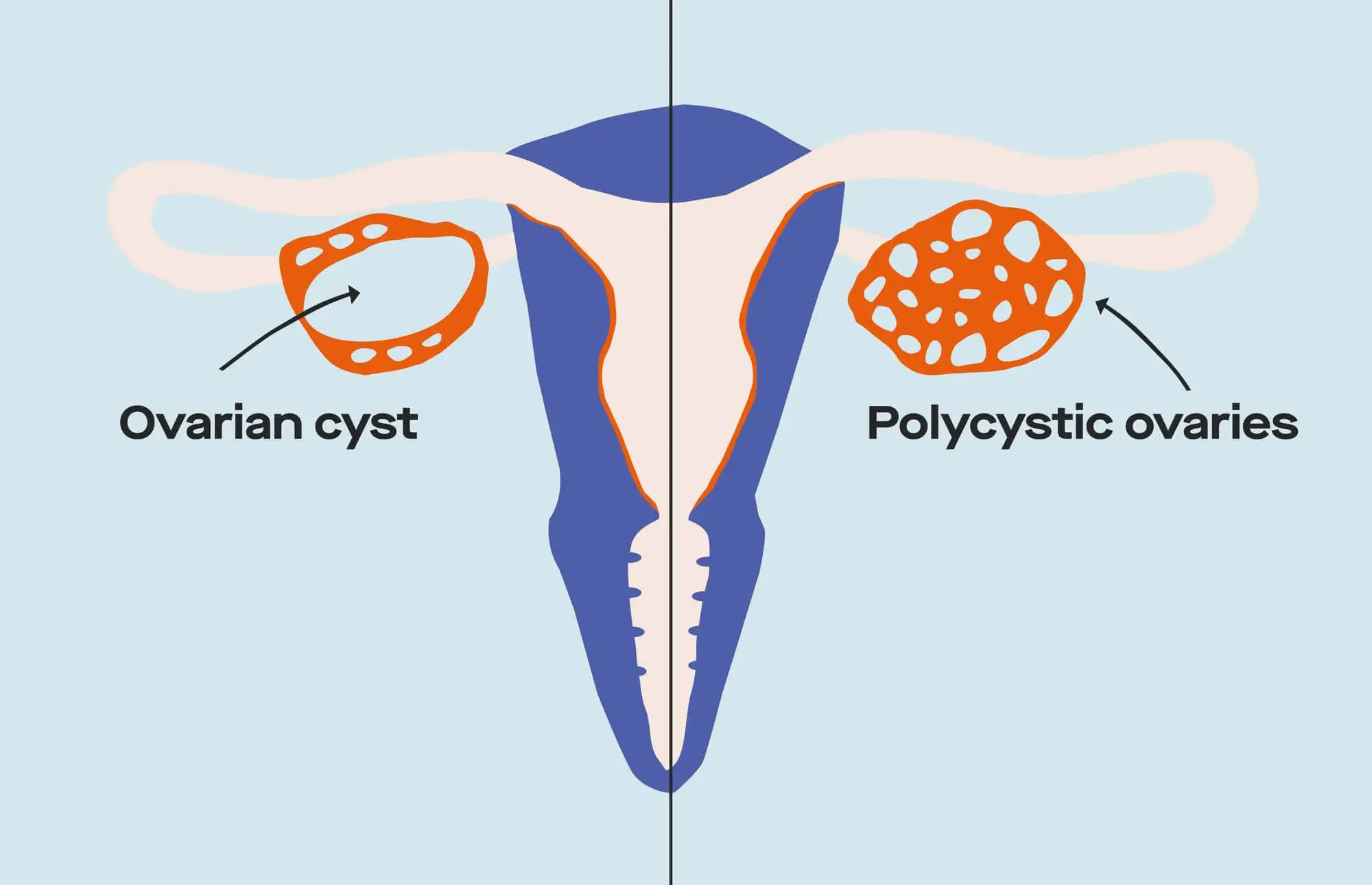 What’s the Difference Between Ovarian Cysts and PCOS? | Ro