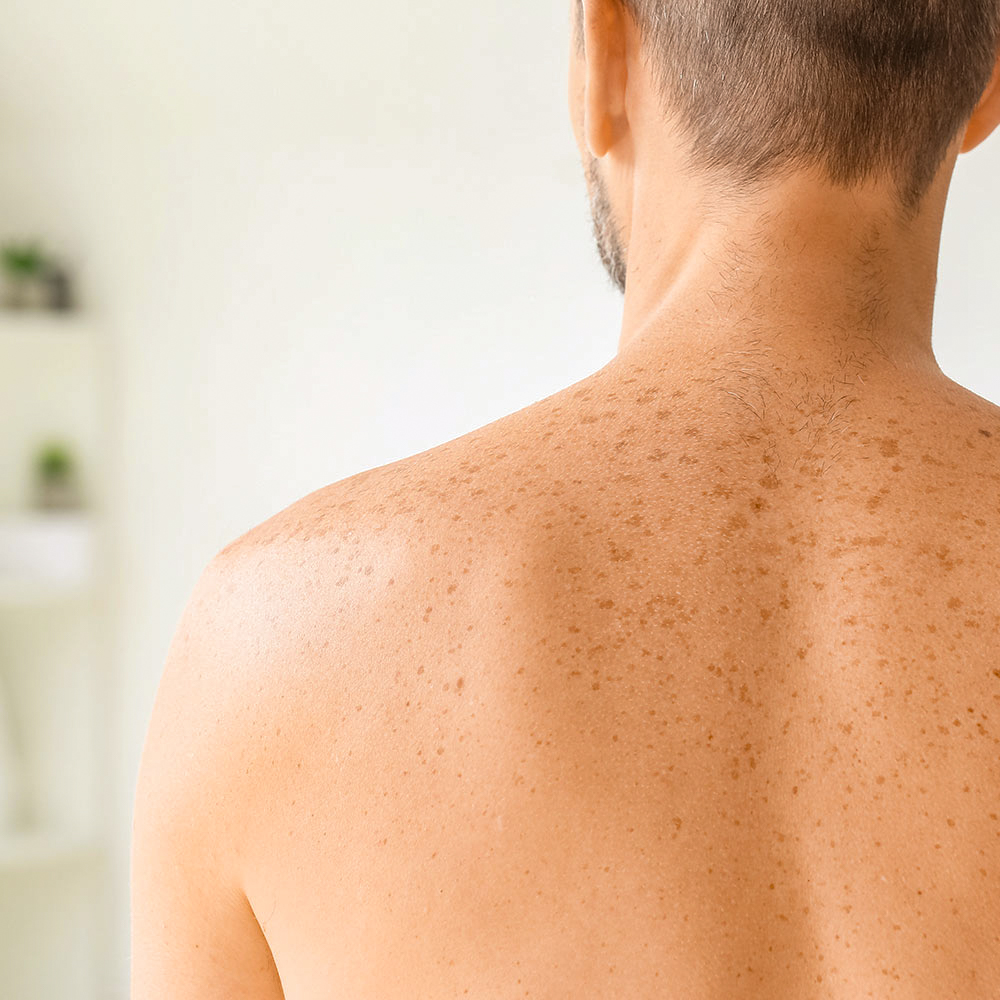 Premature Aging: What Is It & How to Prevent It | Ro