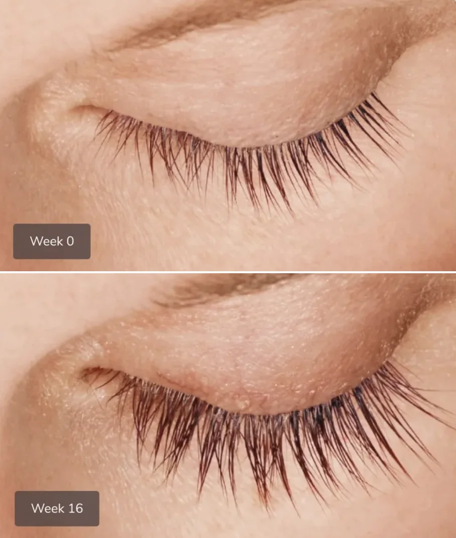 Buy Latisse Online with Prescription - Starting at $99 | Ro
