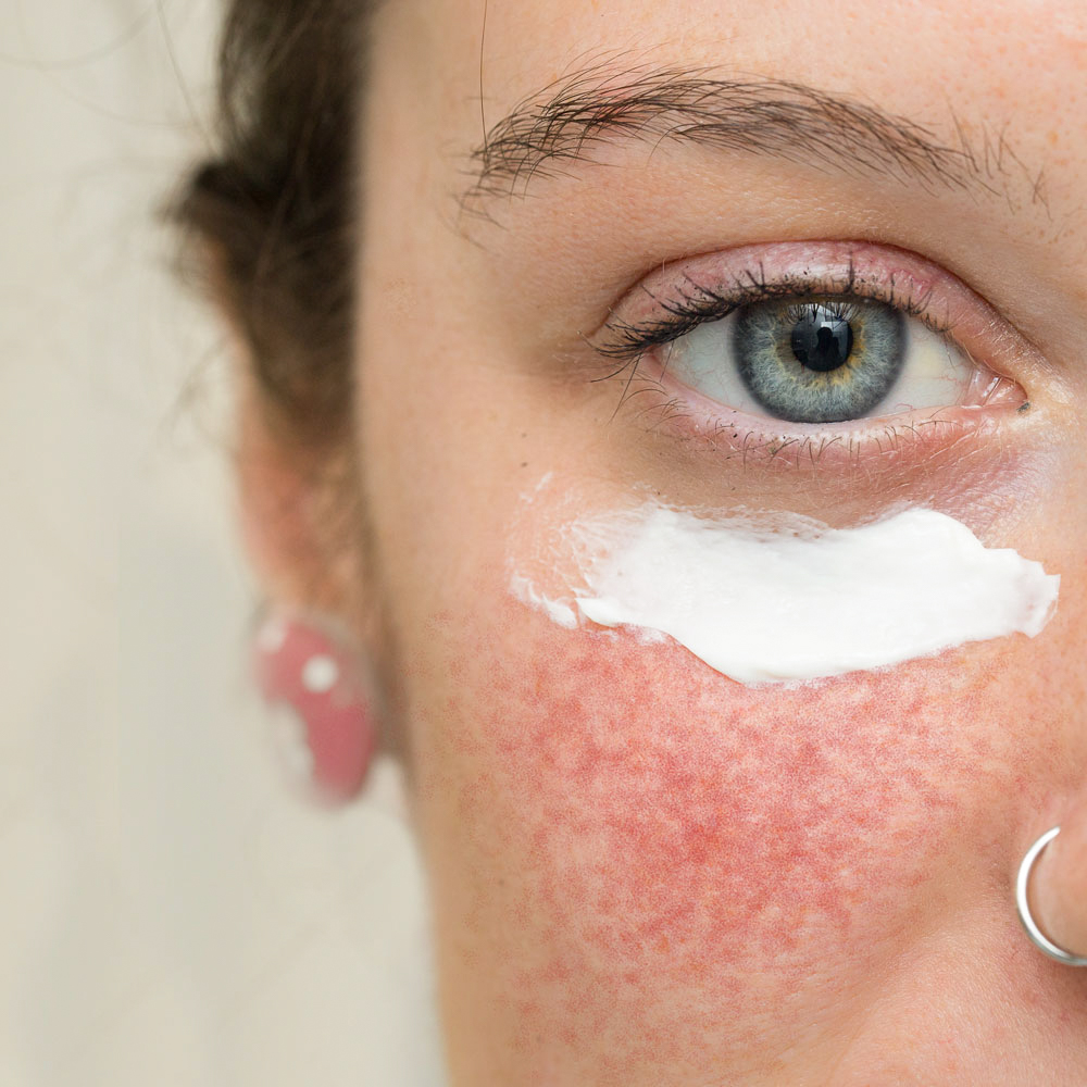 Azelaic Acid: Benefits, Side Effects, What Does It Do | Ro