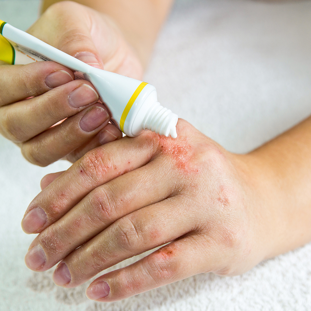 Pustular Psoriasis: What Is It, Symptoms, Types, Treatment | Ro