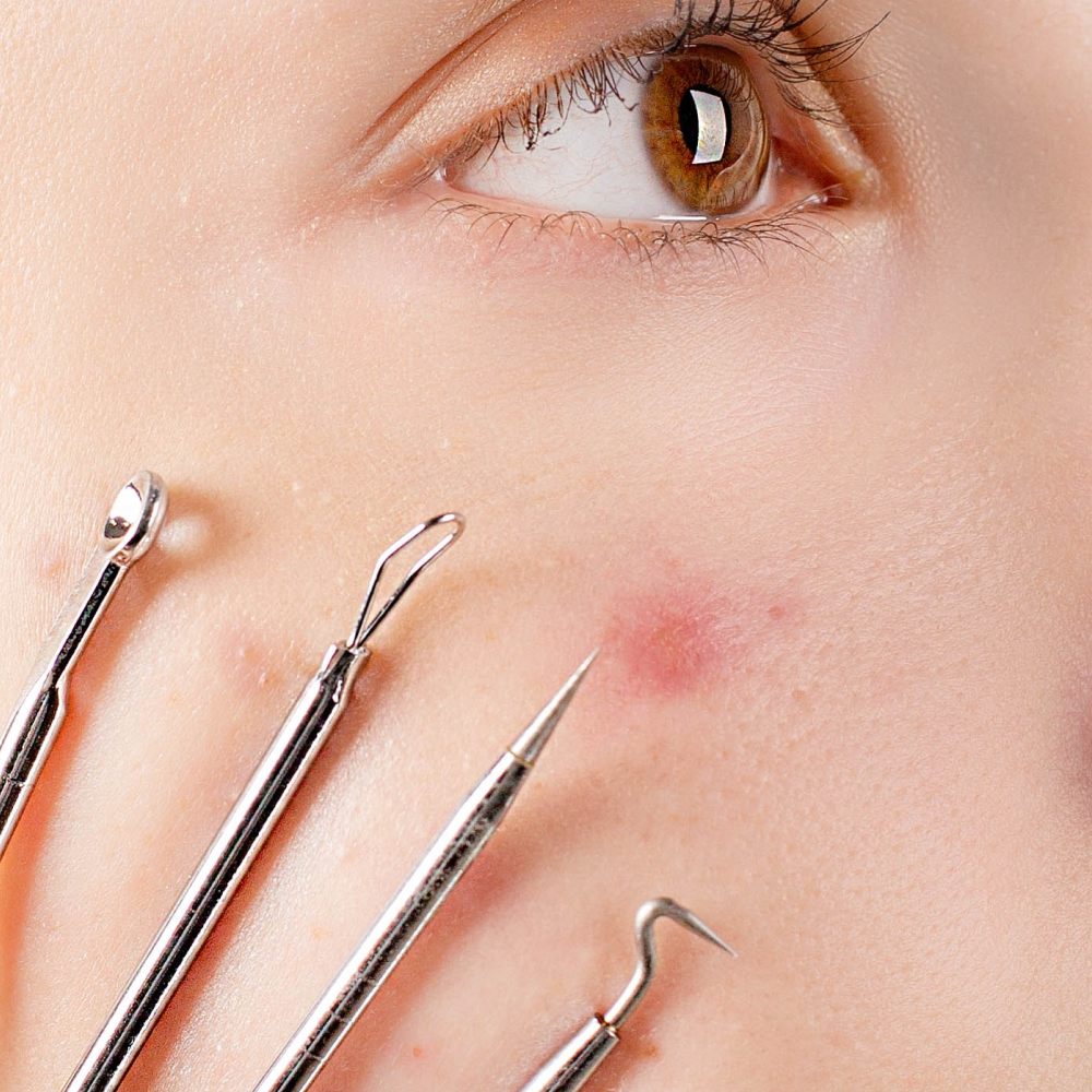 PCOS Acne: Causes and Treatments | Ro