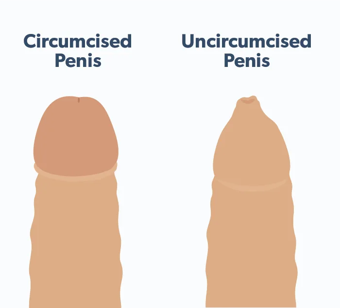 circumcision low cut