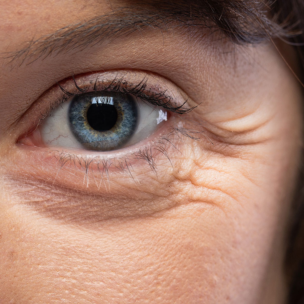 Crow’s Feet: What Are They, Treatment, Prevention | Ro