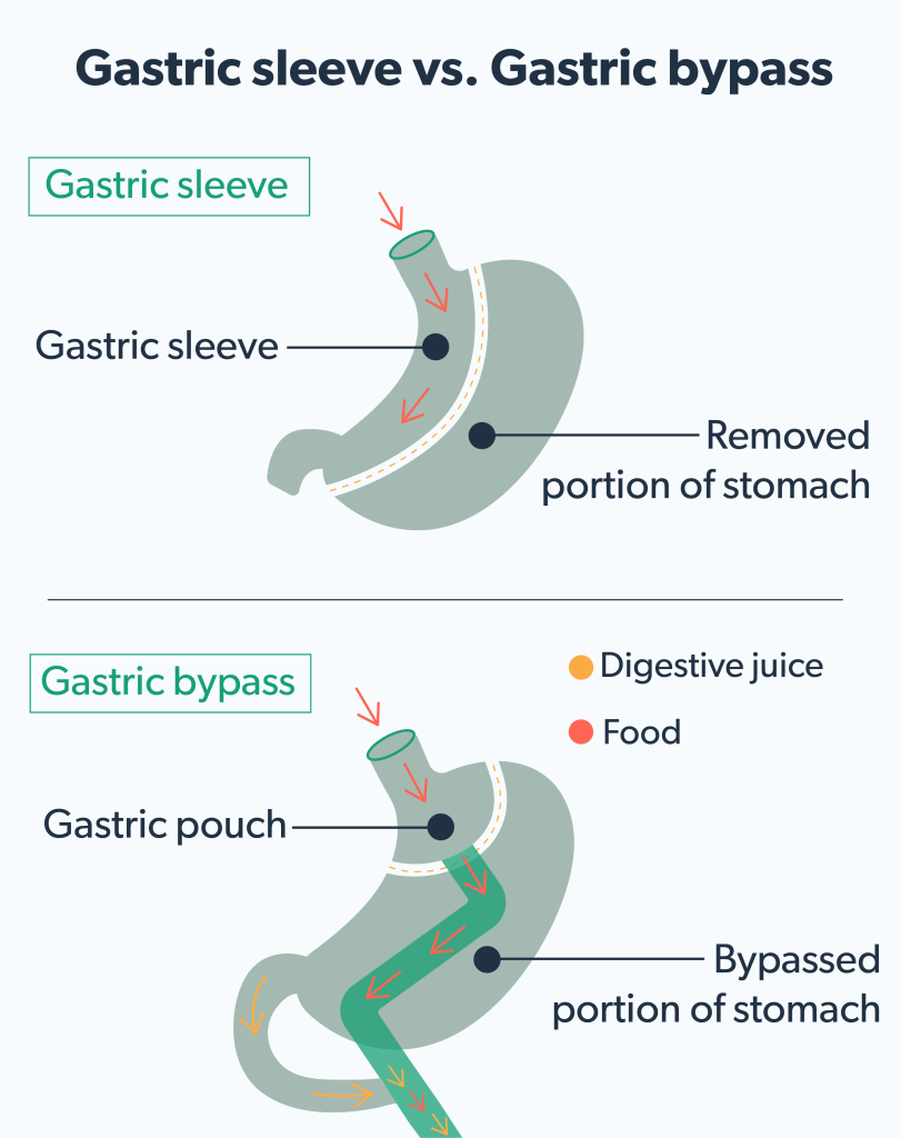 Sleeve Gastrectomy Vs Gastric Bypass