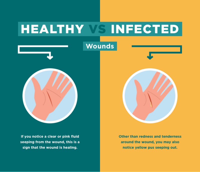 Preventing and Treating Minor Infected Wounds | NEOSPORIN®