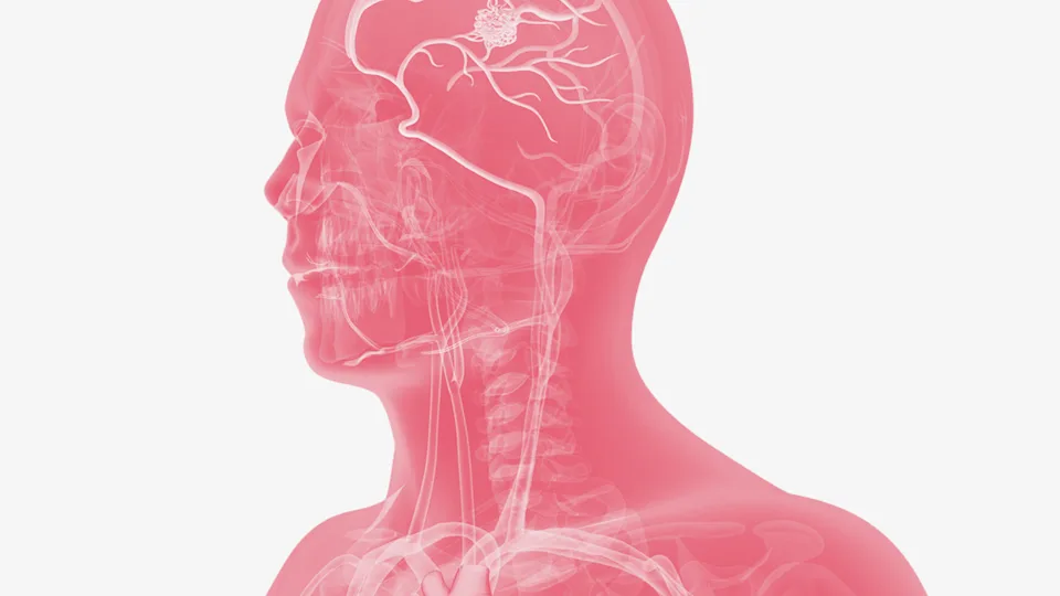 Roadsaver™ | Terumo Neuro