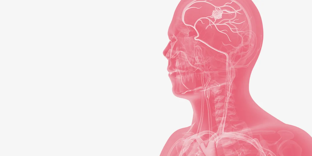 Therapeutic | Terumo Neuro