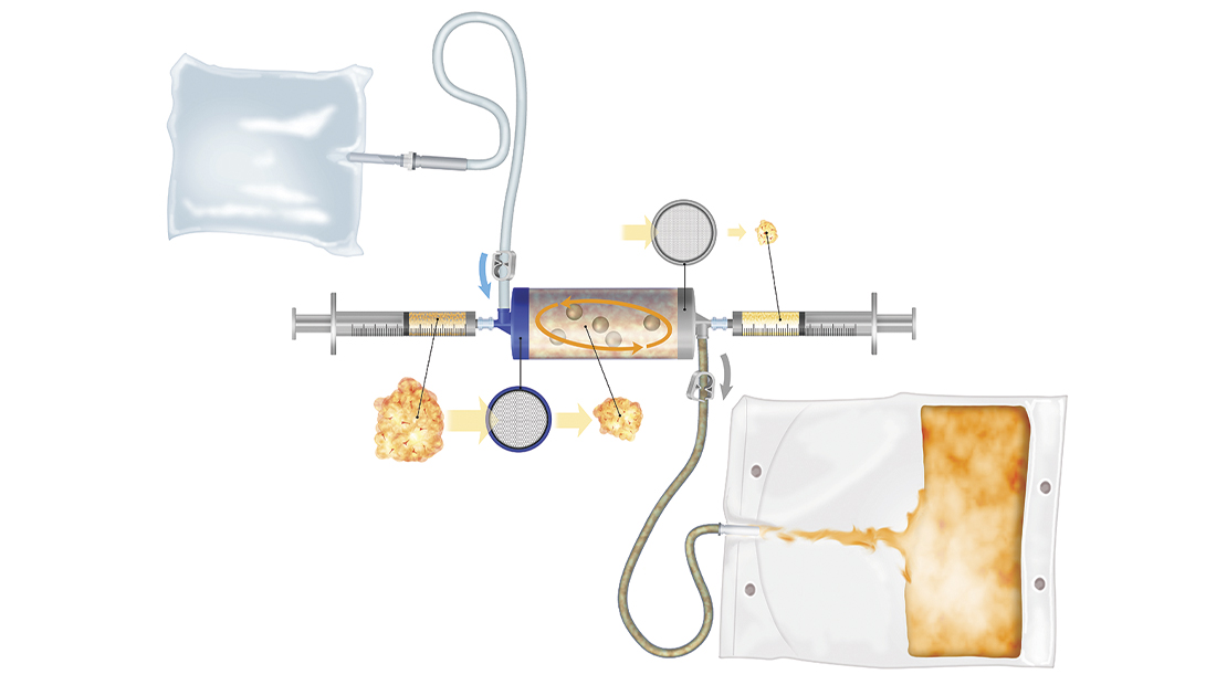 Lipogems As An Alternative To Orthopedic Surgery | Qunomedical