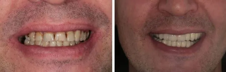 Patient Goes To Croatia For Affordable Dental Treatment | Qunomedical