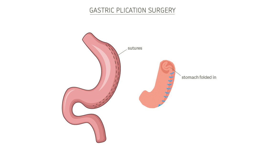 Weight Loss Surgery Costs in the UK & Abroad | Qunomedical