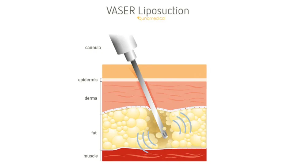 VASER Liposuction - At Home and Abroad | Qunomedical