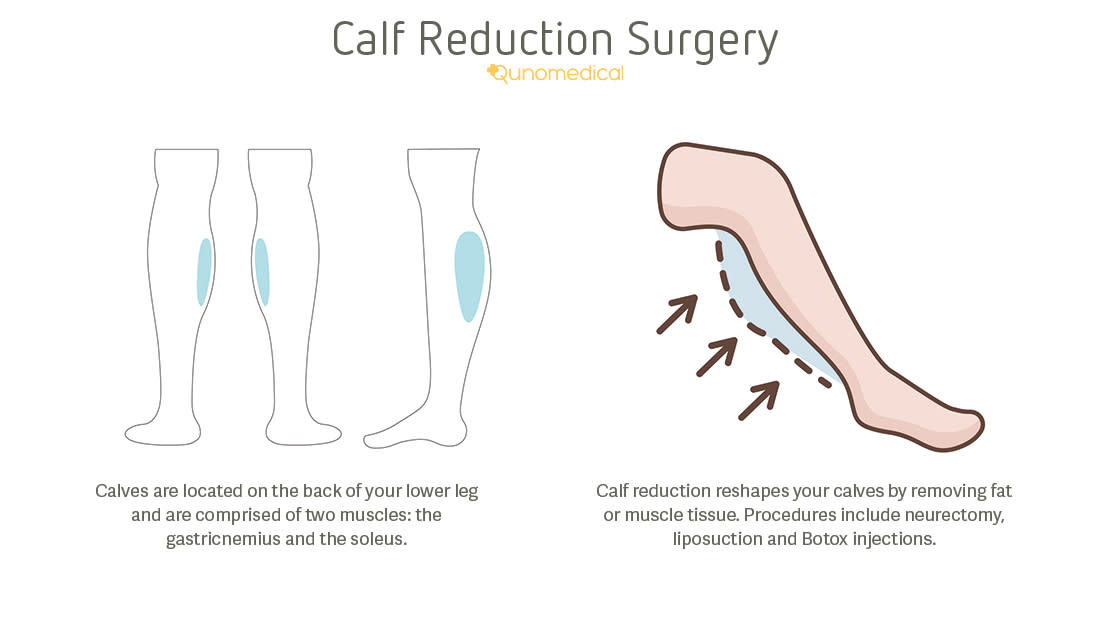 Calf Reduction: Pros & Cons of Selective Neurectomy | Qunomedical