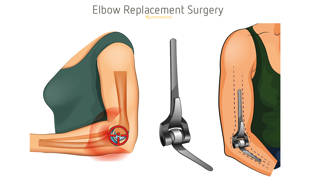 Elbow Arthroplasty: Types, Procedure, Recovery, And FAQs, 41% OFF