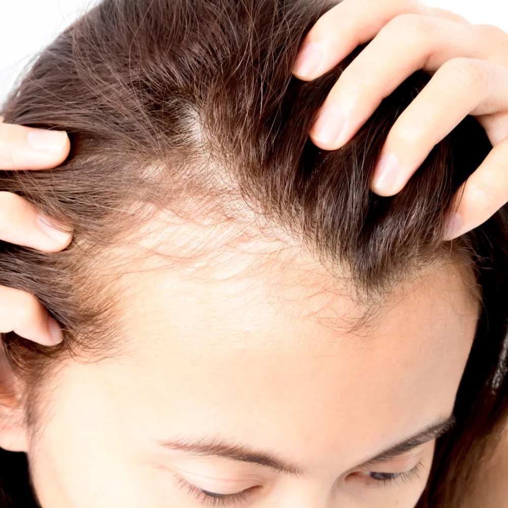Female Hair Transplants: All You Need to Know | Qunomedical