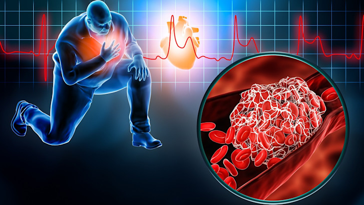 Helpful App — Definition of Myocardial Infarction (Heart Attack)