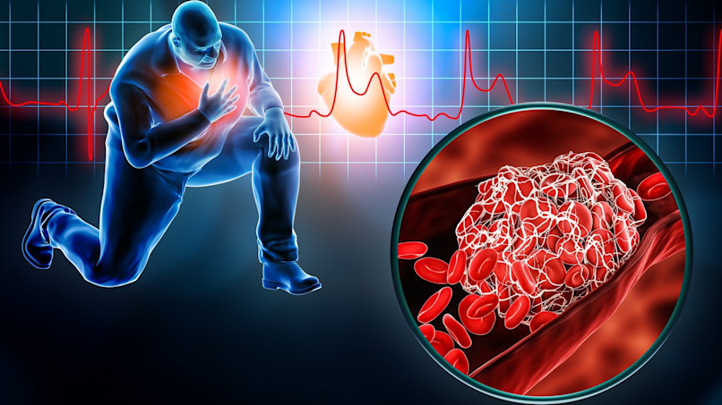 Helpful App — Definition of Myocardial Infarction (Heart Attack)
