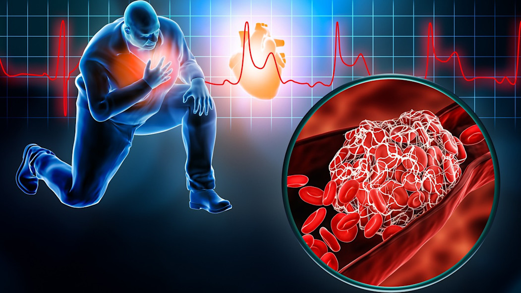 Helpful App — Definition of Myocardial Infarction (Heart Attack)